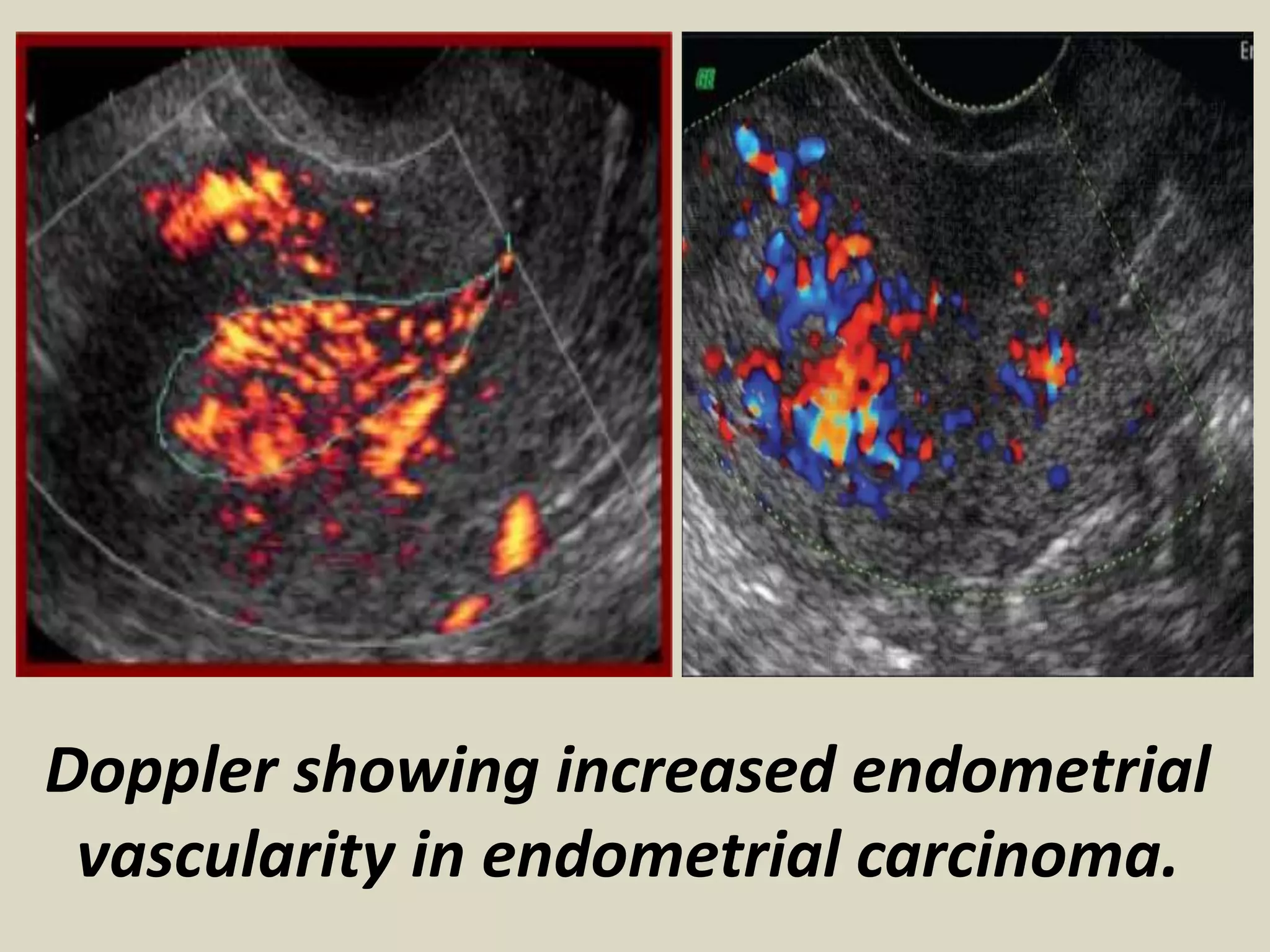 Presentation1, radiological imaging of endometrial carcinoma. | PPTX