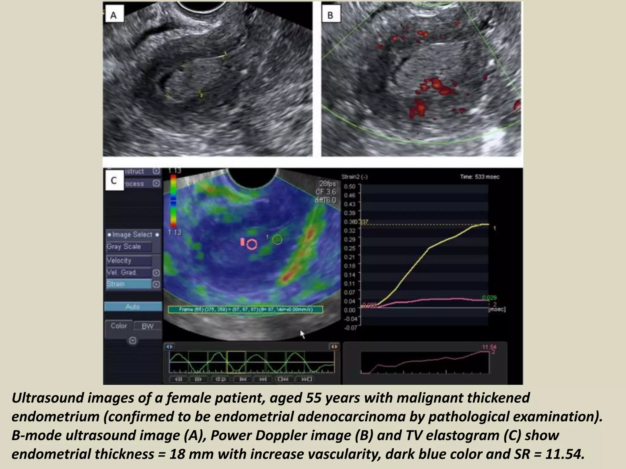 Presentation1, radiological imaging of endometrial carcinoma. | PPTX