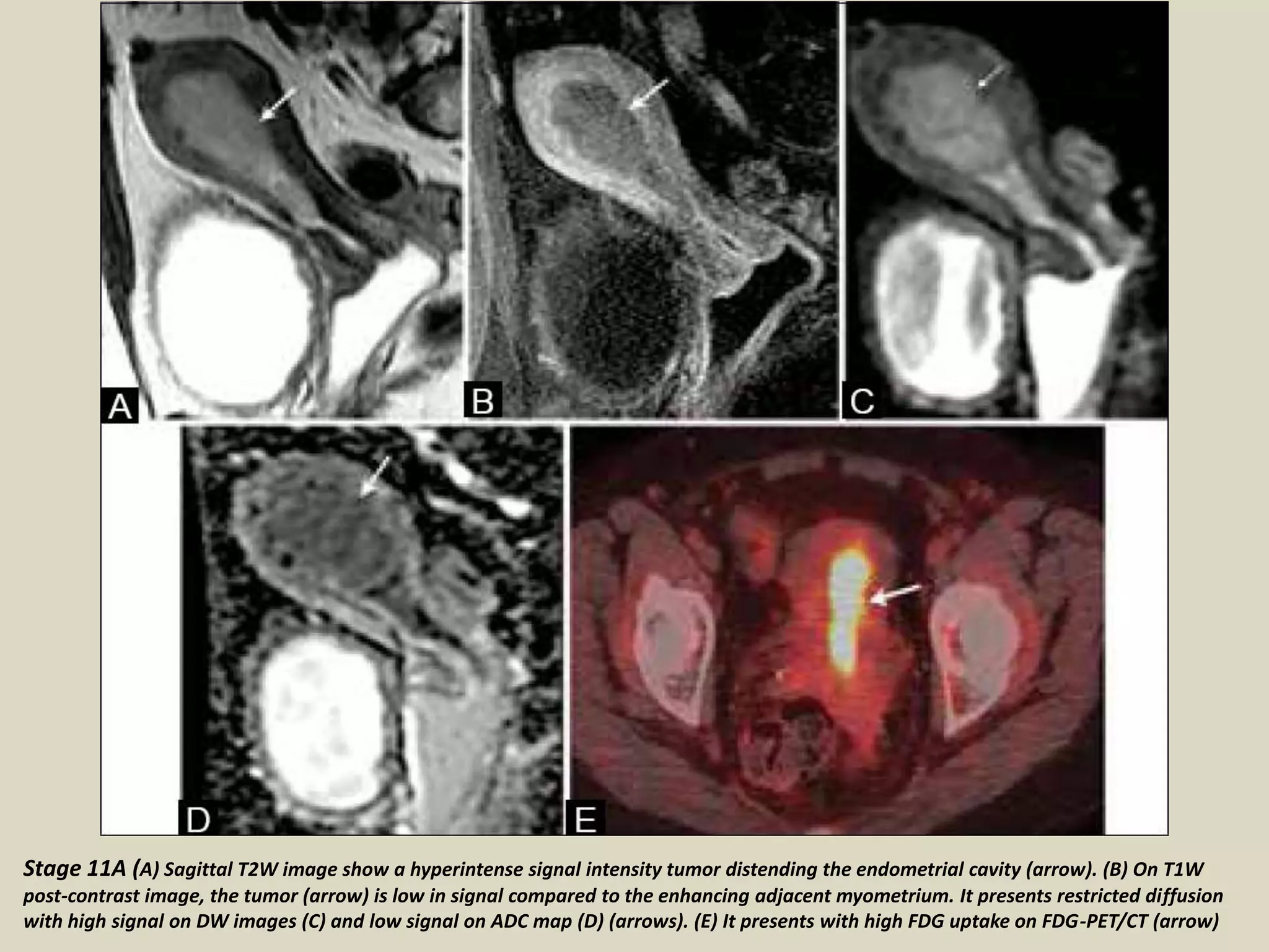 Presentation1, radiological imaging of endometrial carcinoma. | PPTX