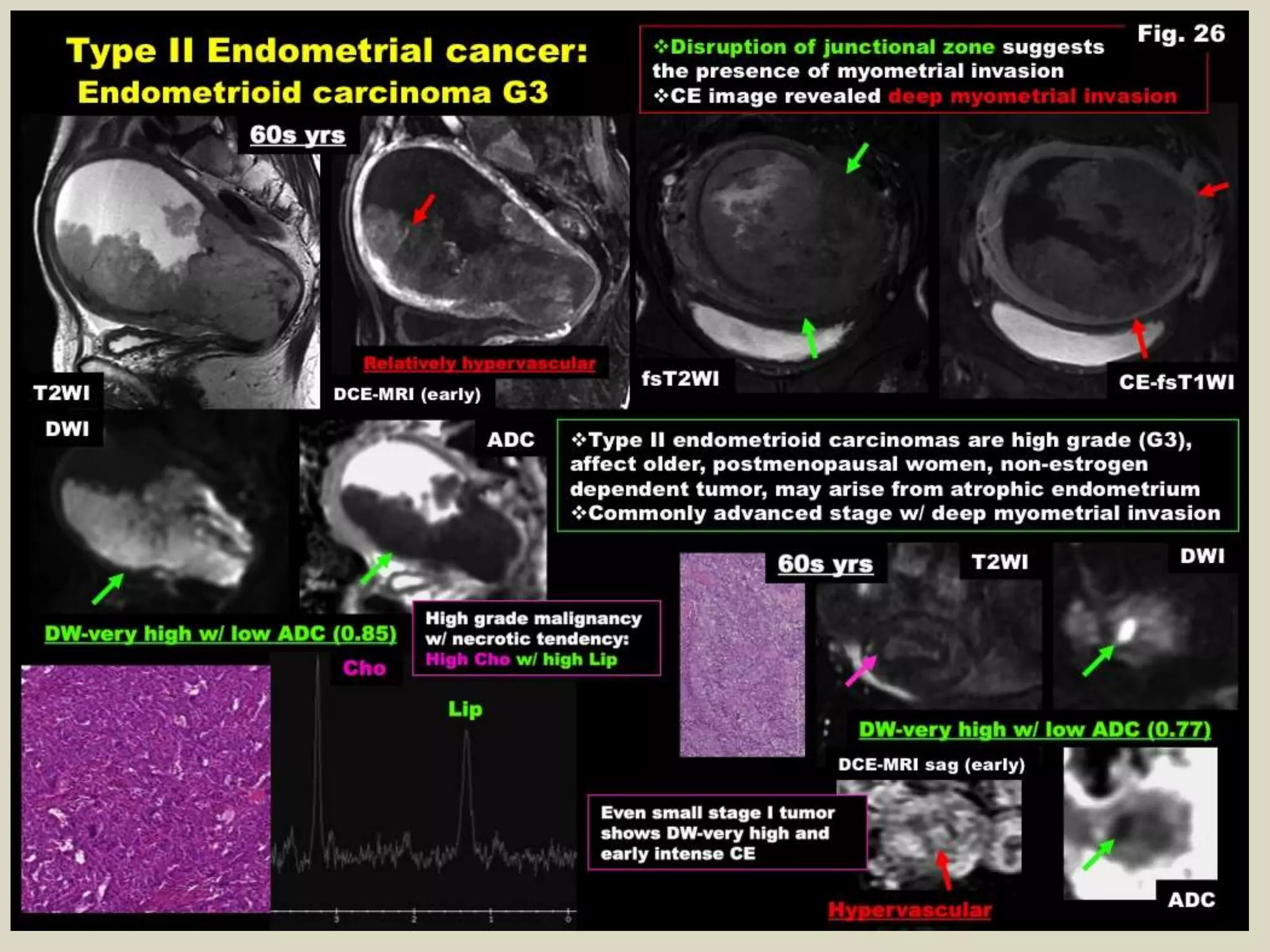 Presentation1, radiological imaging of endometrial carcinoma. | PPTX