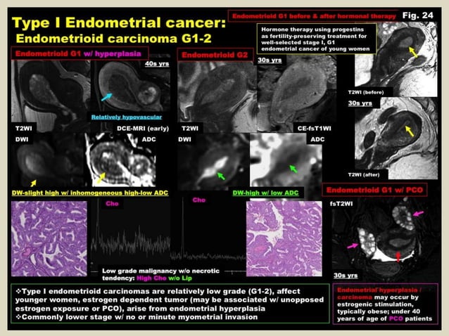 Presentation1, radiological imaging of endometrial carcinoma. | PPTX ...