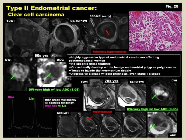 Presentation1, radiological imaging of endometrial carcinoma. | PPTX | Reproductive Health ...