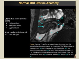 Uterus Anatomy Mri