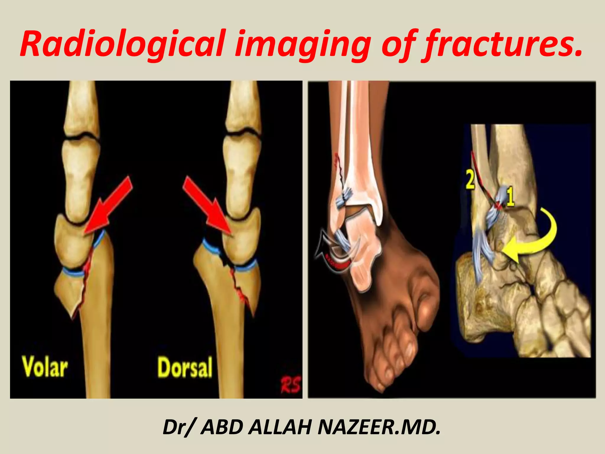 Presentation1, radiological imaging of fractures. | PPTX