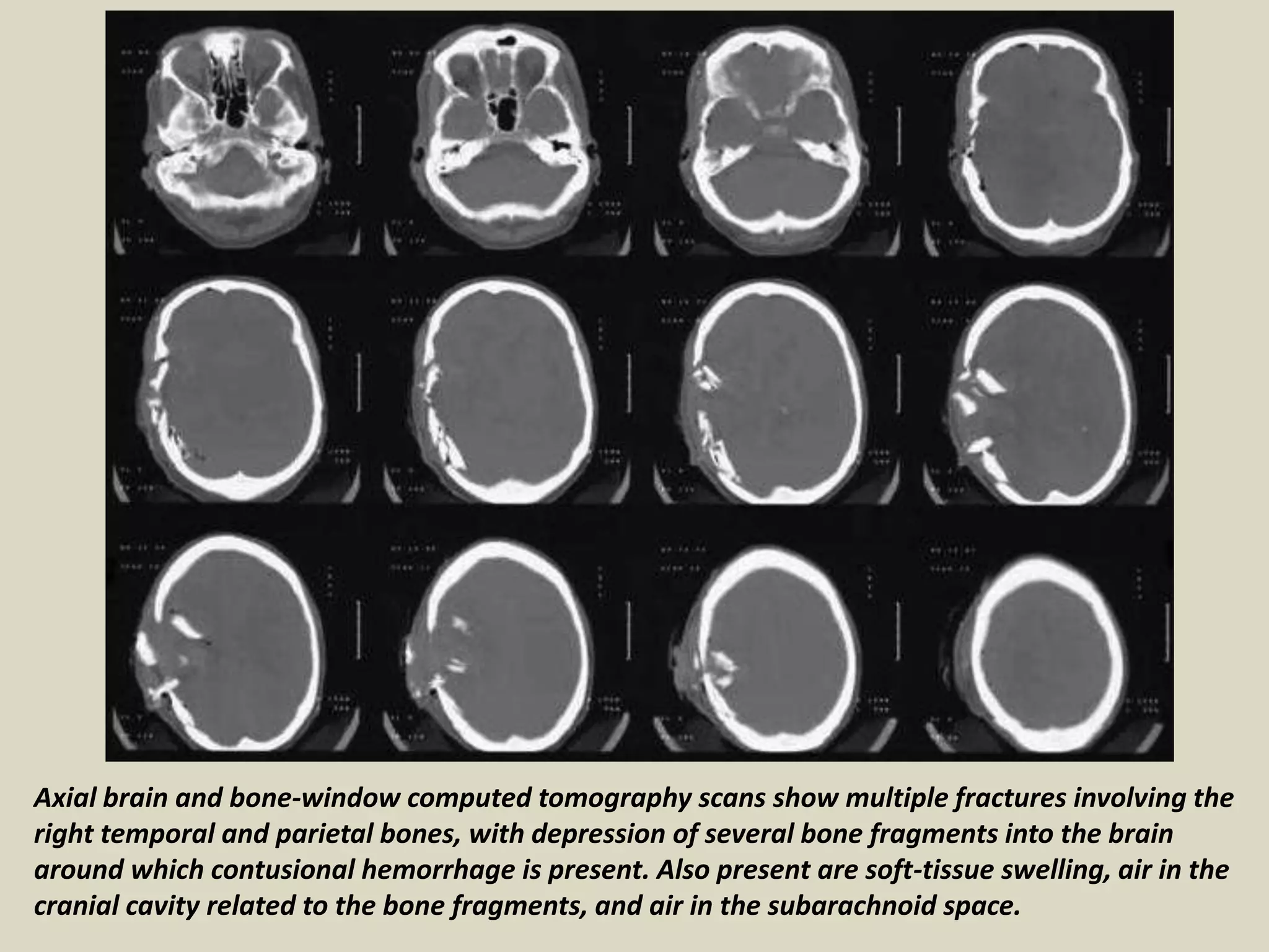 Presentation1, radiological imaging of fractures. | PPTX
