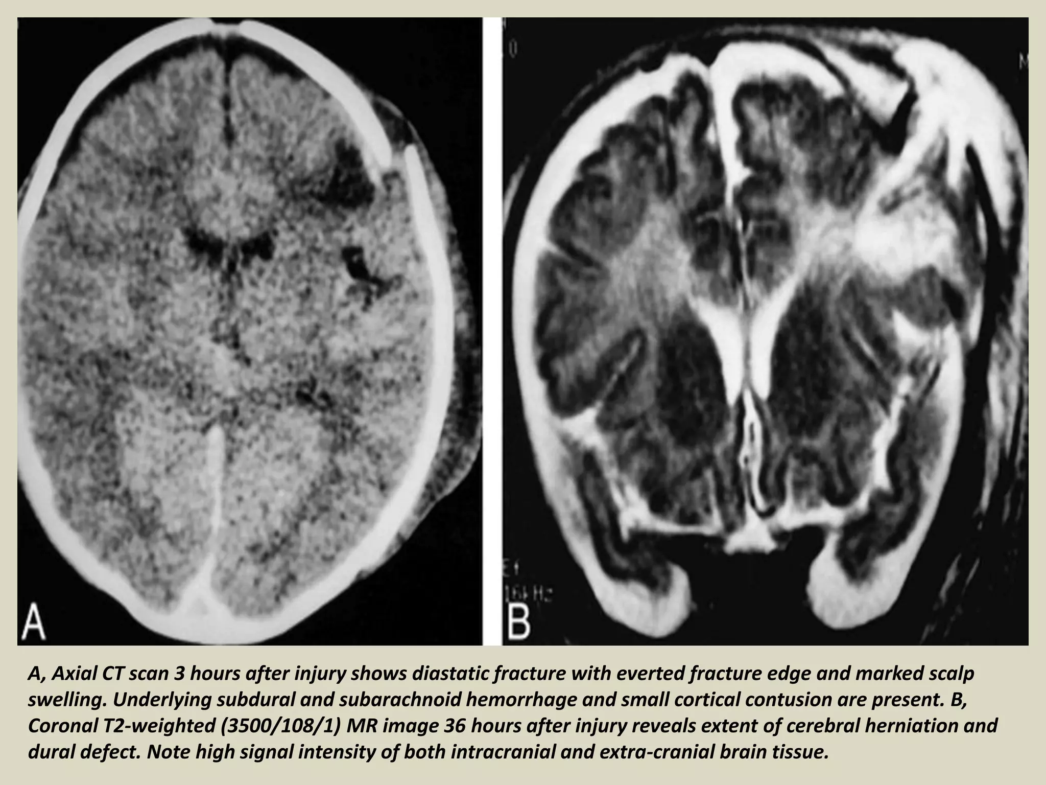 Presentation1, radiological imaging of fractures. | PPTX