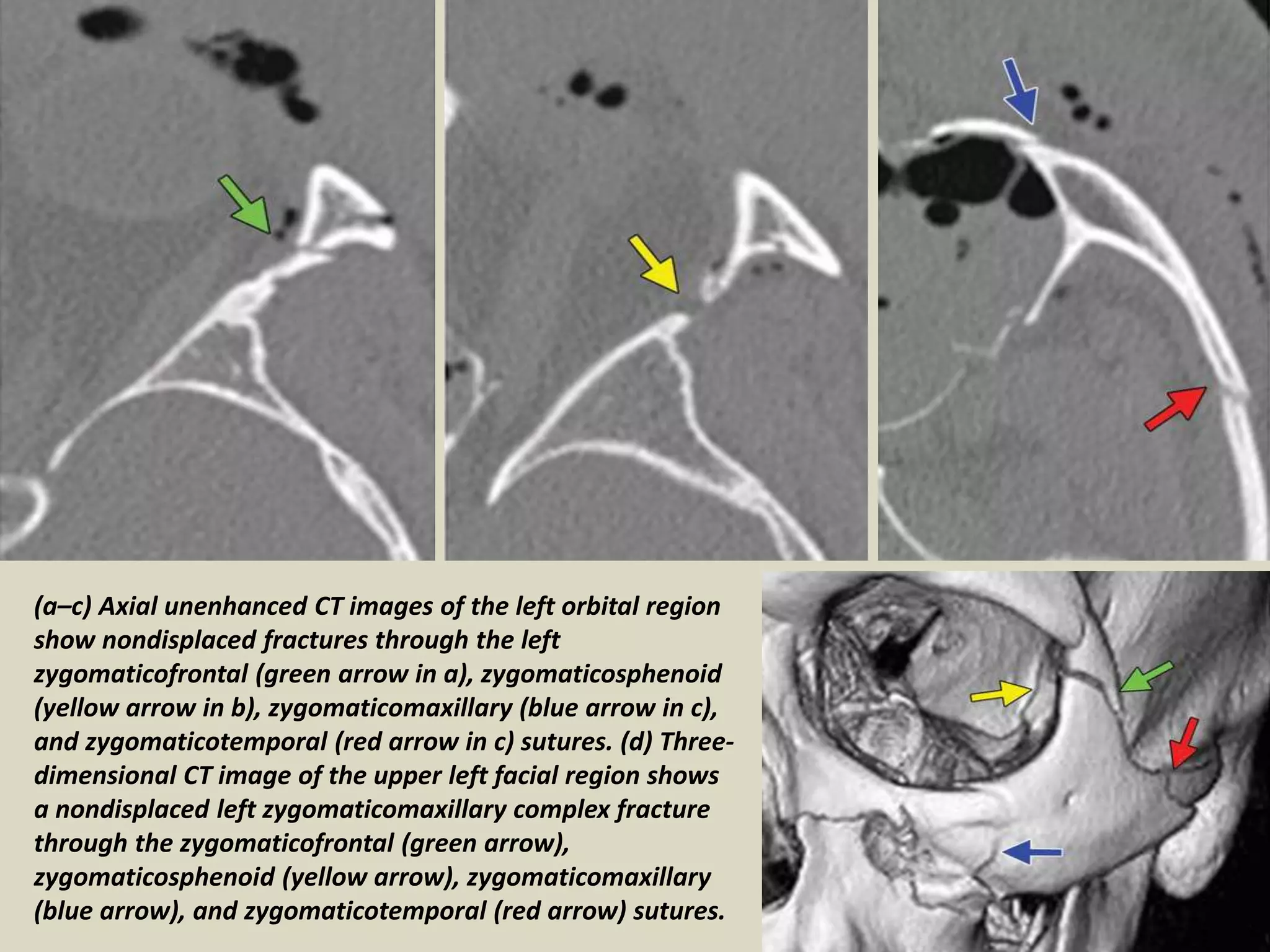 Presentation1, radiological imaging of fractures. | PPTX
