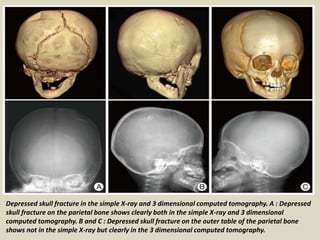 Presentation1, radiological imaging of fractures. | PPTX