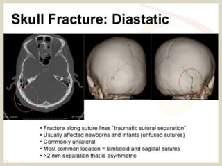 Diastatic Skull Fracture X Ray