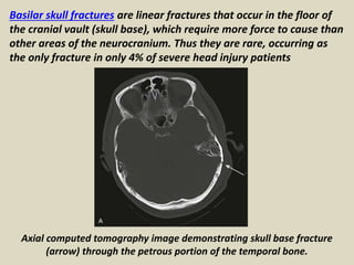Presentation1, radiological imaging of fractures. | PPTX