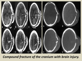 Presentation1, radiological imaging of fractures. | PPTX