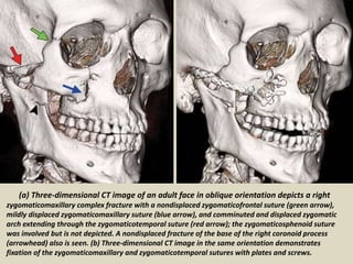 Presentation1, radiological imaging of fractures. | PPTX
