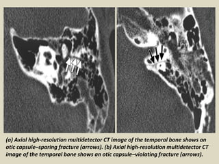 Presentation1, radiological imaging of fractures. | PPTX