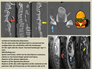 Presentation1, radiological imaging of fractures. | PPTX