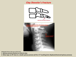 Presentation1, radiological imaging of fractures. | PPTX