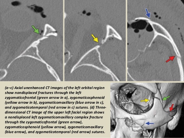 Zygomaticofrontal Suture Ct