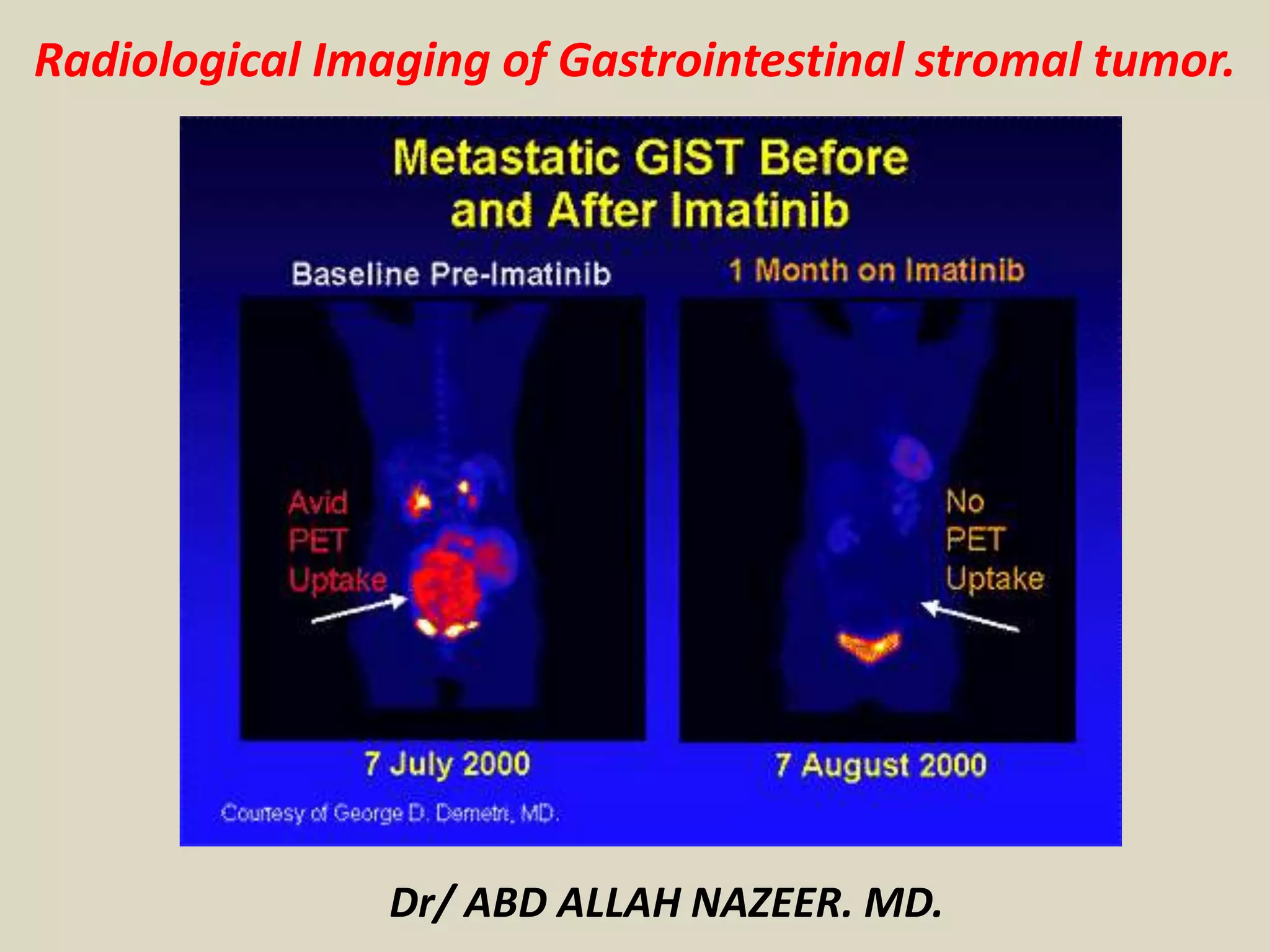 Presentation1, radiological imaging of gastro intestinal stromal tumour ...