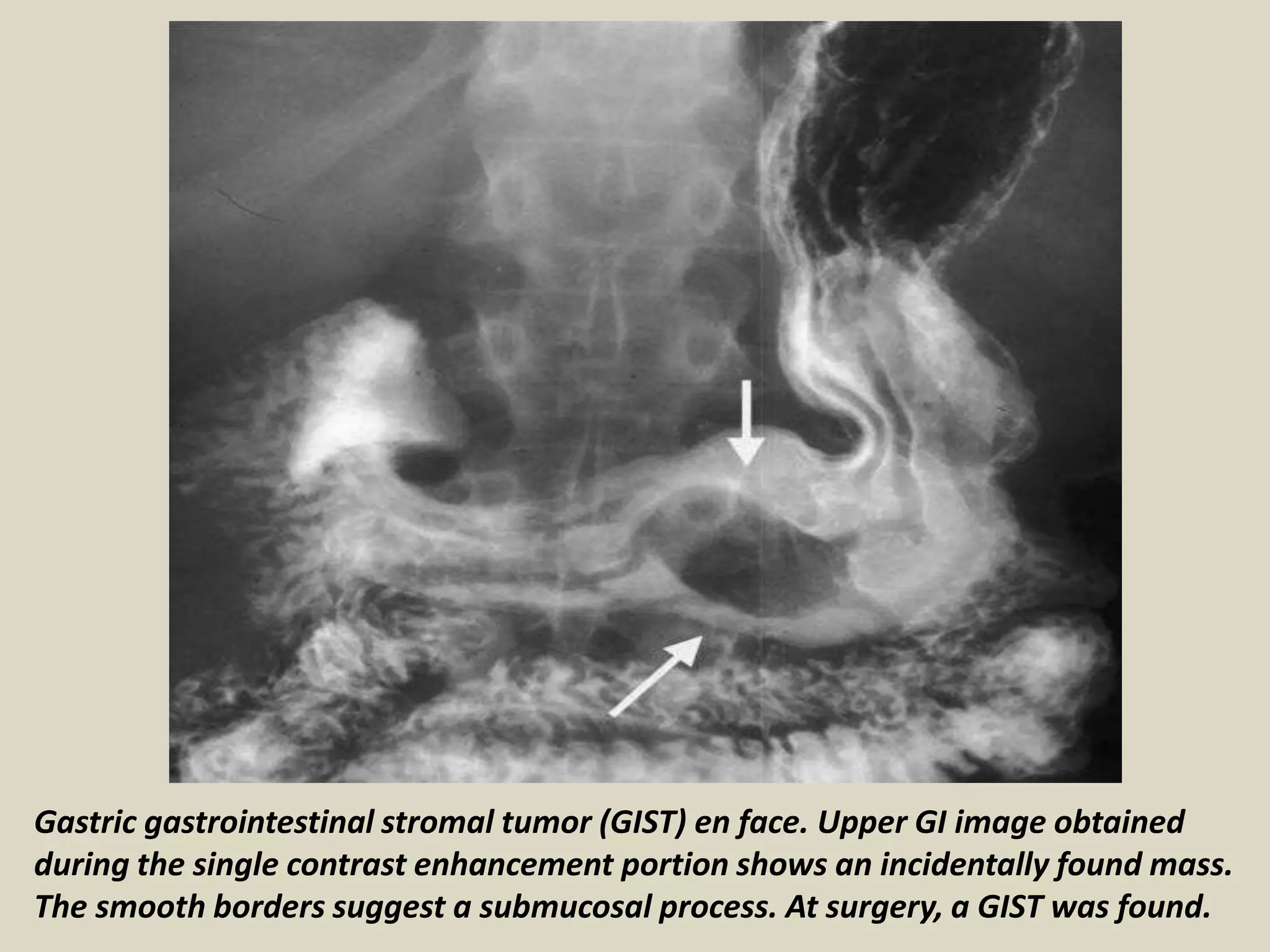 Presentation1, radiological imaging of gastro intestinal stromal tumour ...
