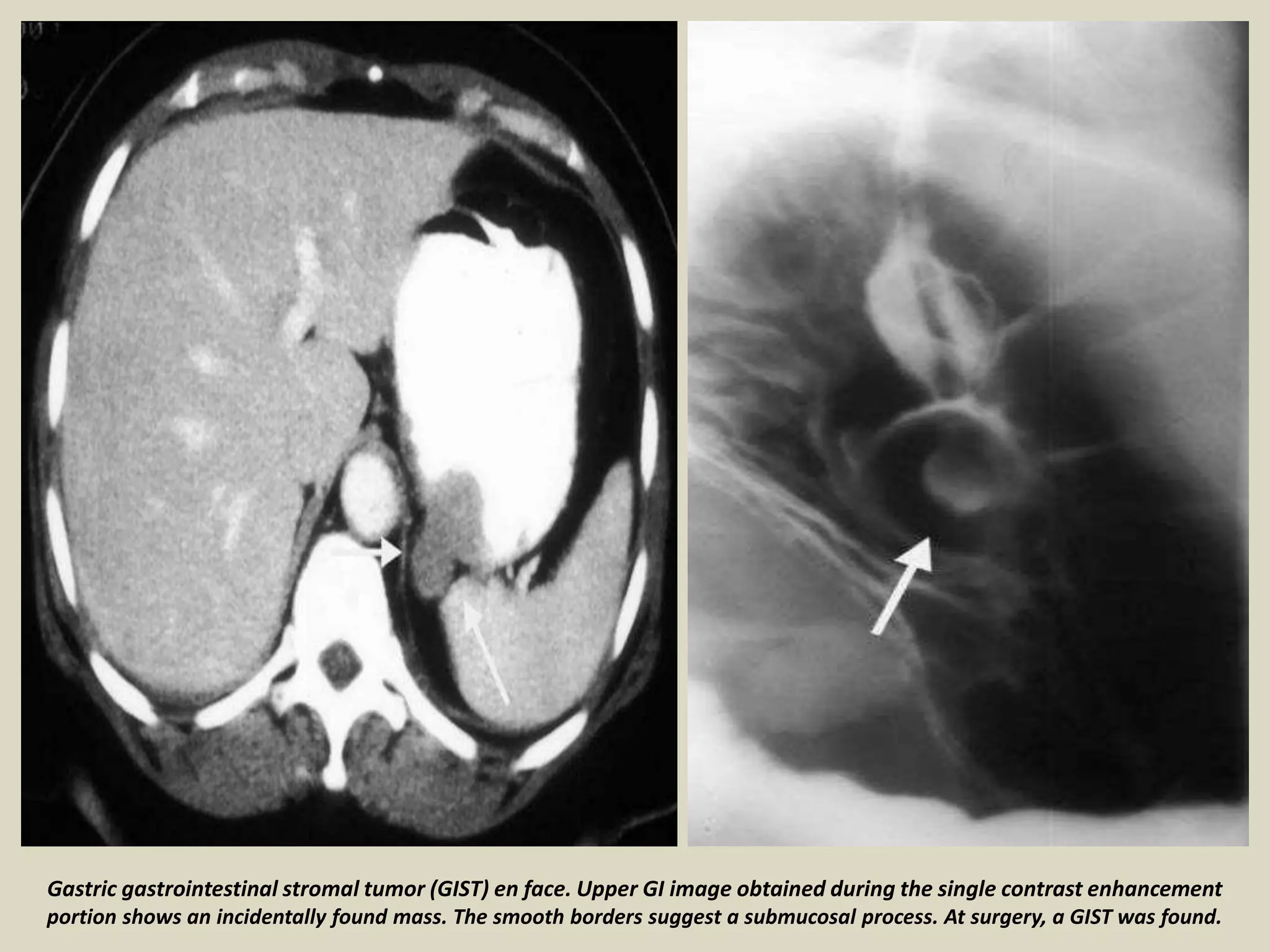 Presentation1, radiological imaging of gastro intestinal stromal tumour ...