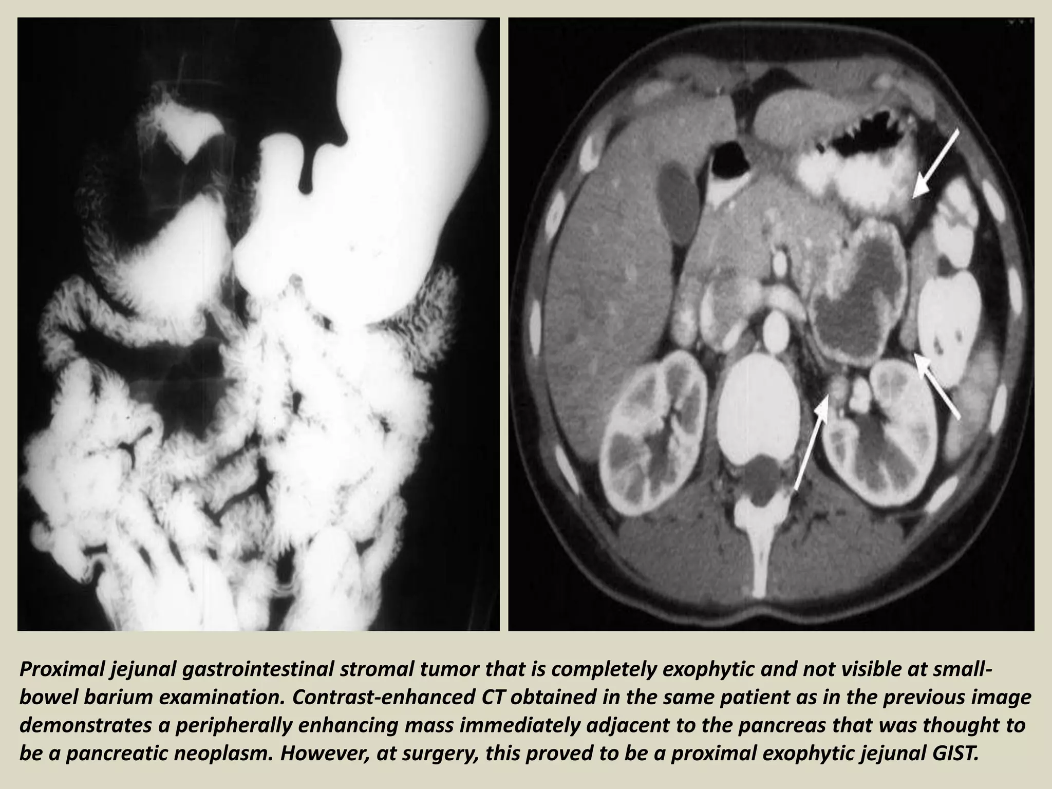 Presentation1, radiological imaging of gastro intestinal stromal tumour ...