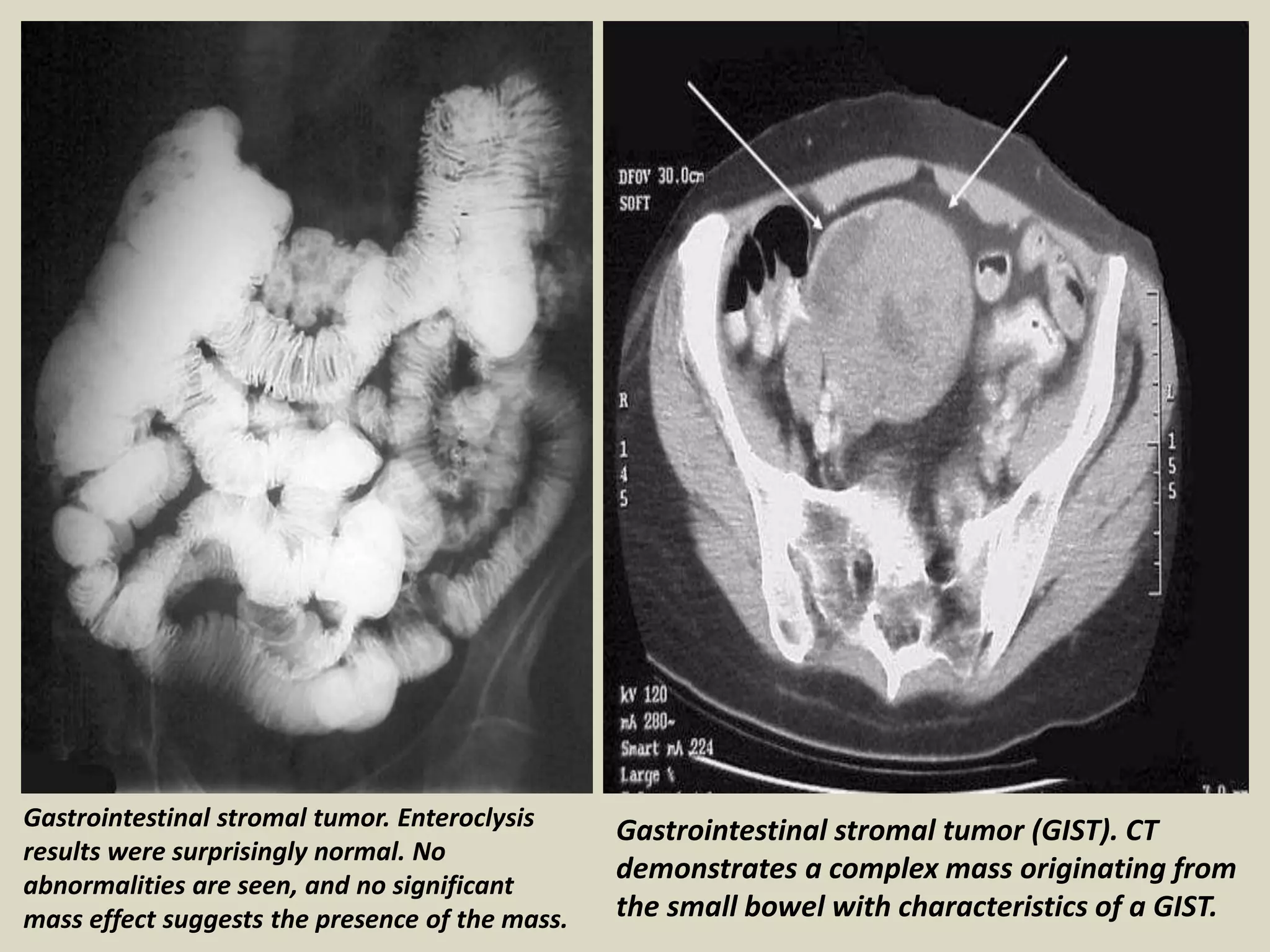 Presentation1, radiological imaging of gastro intestinal stromal tumour ...