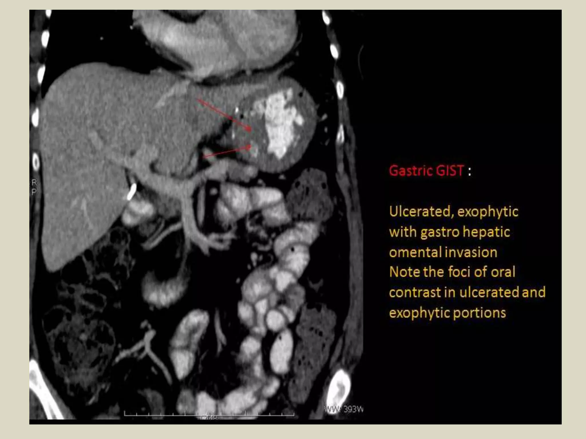 Presentation1, radiological imaging of gastro intestinal stromal tumour ...