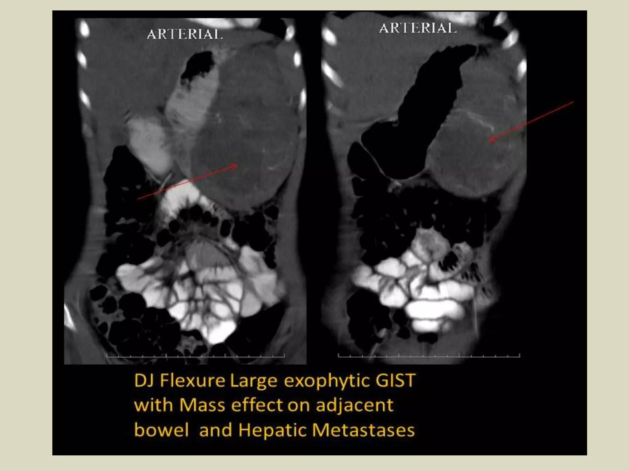 Presentation1, radiological imaging of gastro intestinal stromal tumour ...