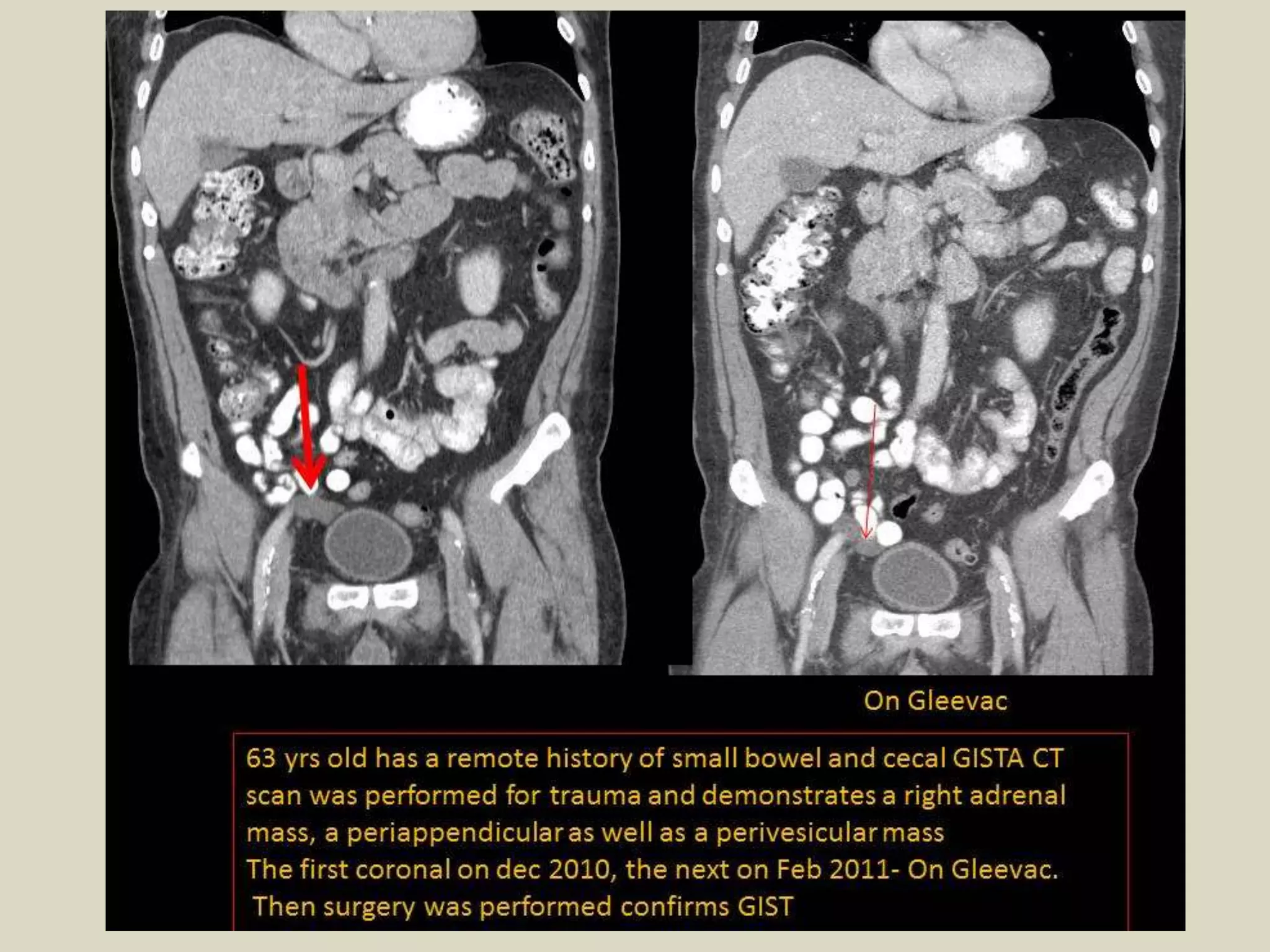 Presentation1, radiological imaging of gastro intestinal stromal tumour ...