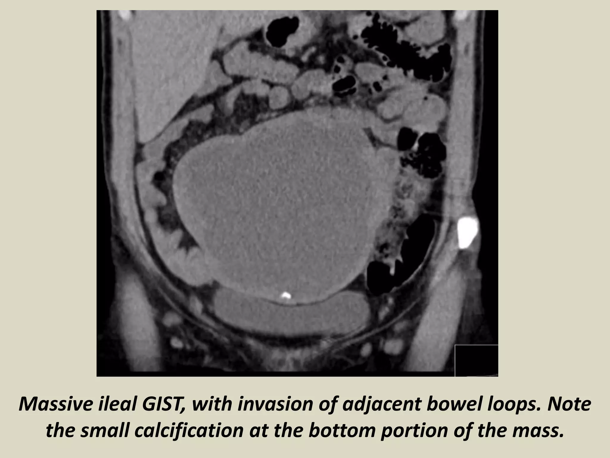 Presentation1, radiological imaging of gastro intestinal stromal tumour ...