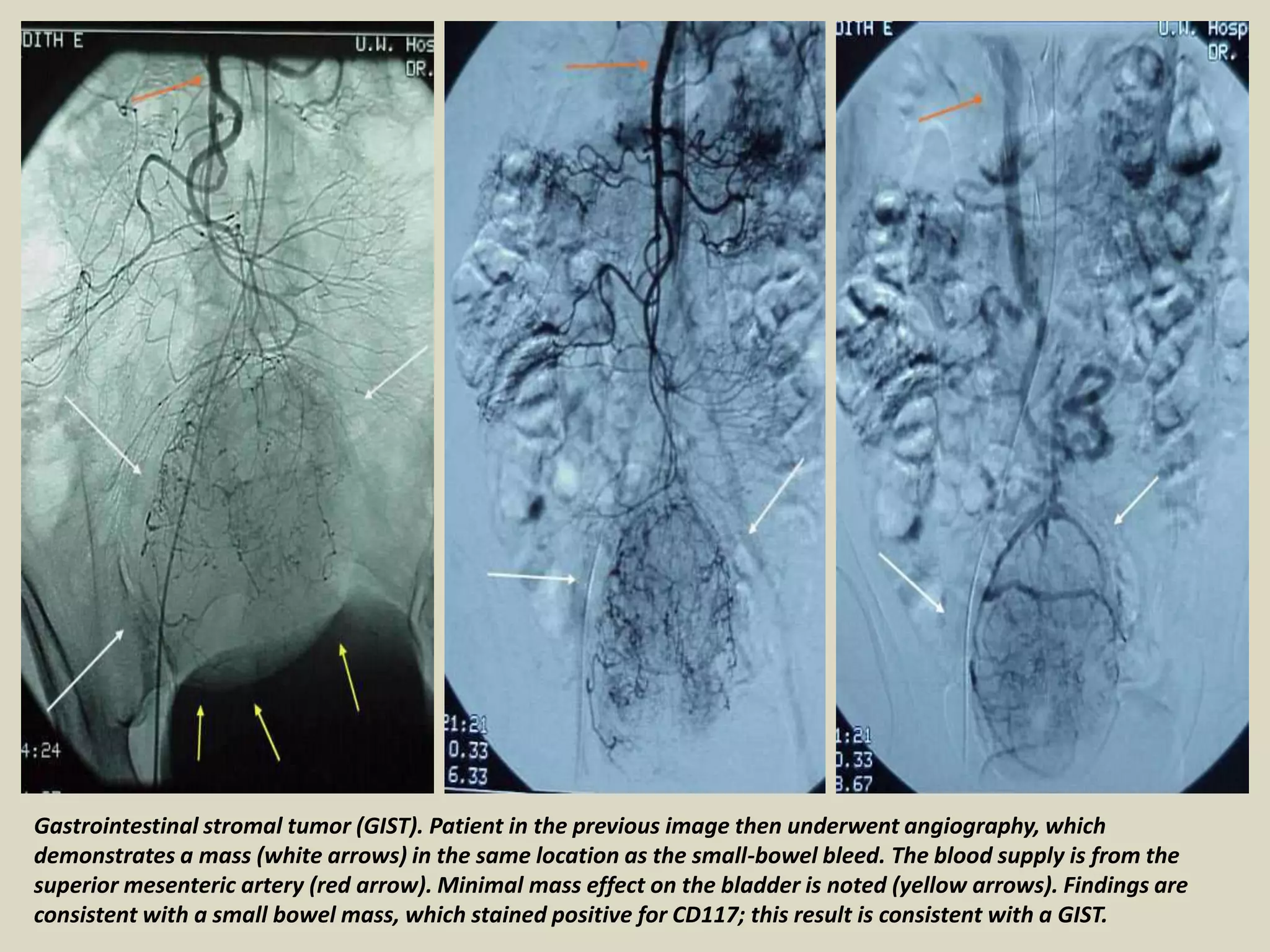 Presentation1, radiological imaging of gastro intestinal stromal tumour ...