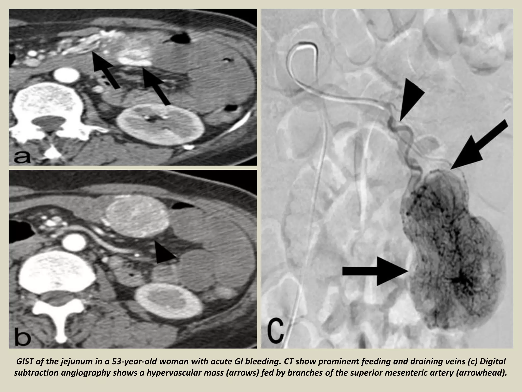 Presentation1, radiological imaging of gastro intestinal stromal tumour ...