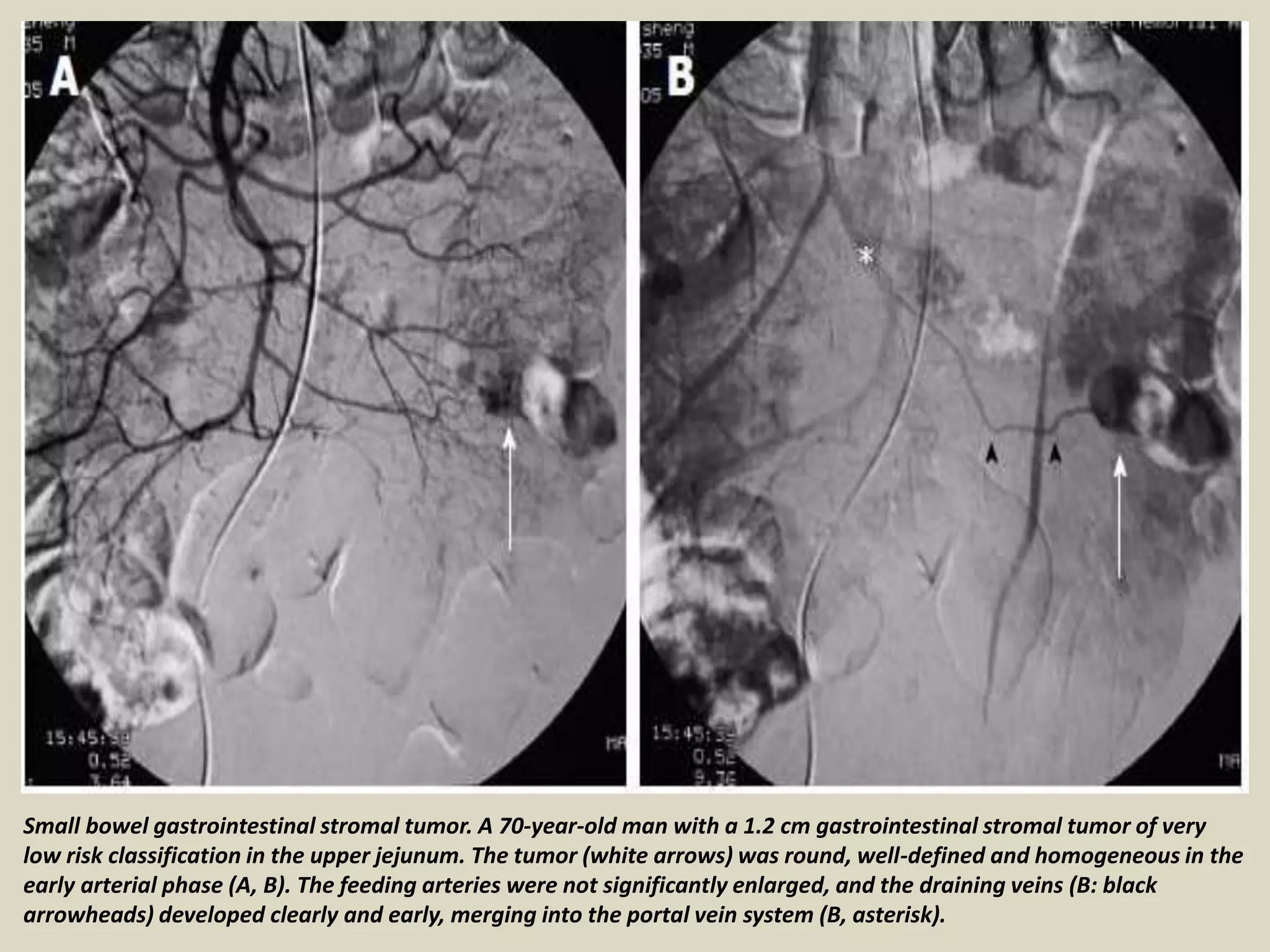 Presentation1, radiological imaging of gastro intestinal stromal tumour ...