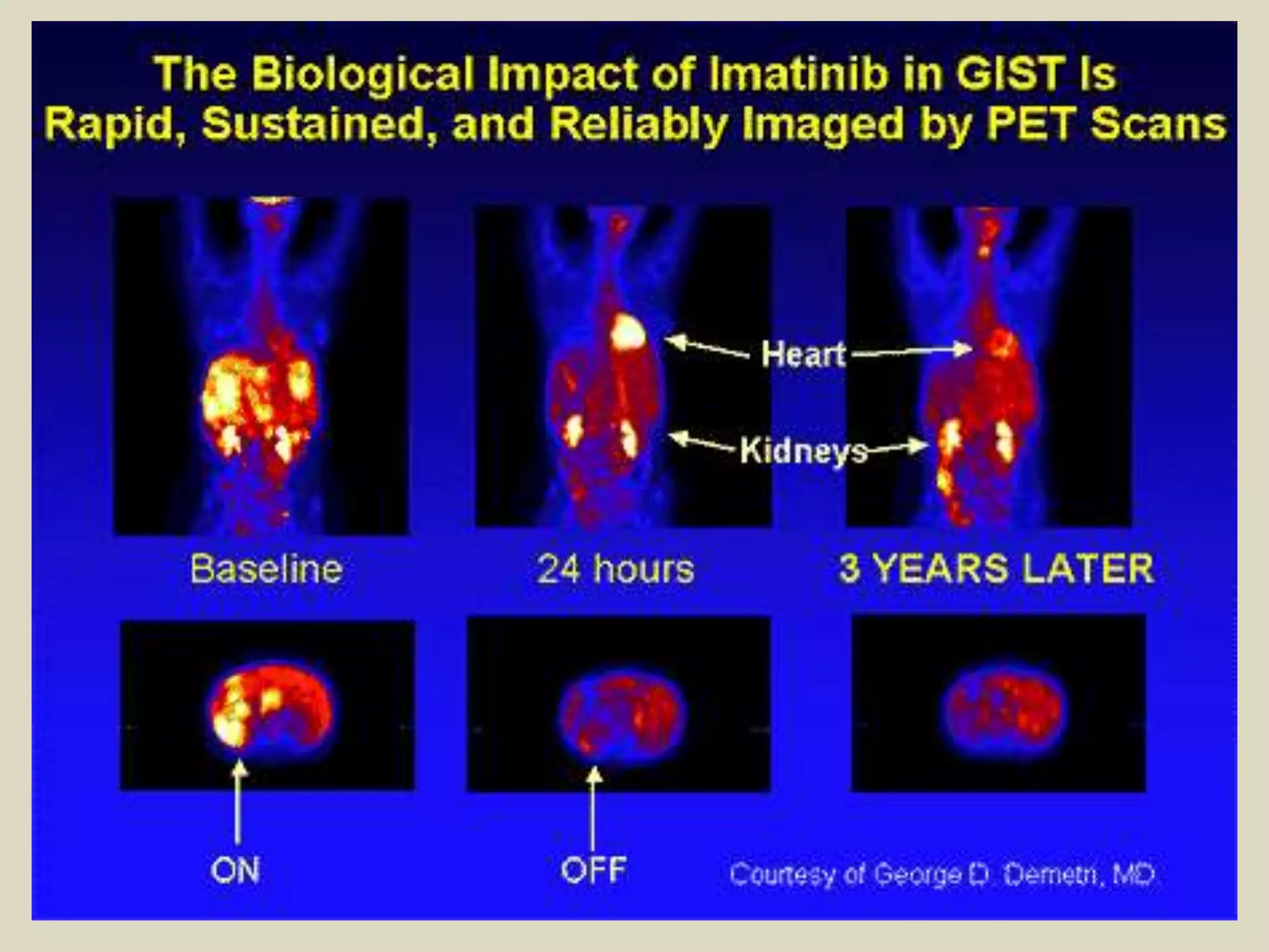 Presentation1, radiological imaging of gastro intestinal stromal tumour ...