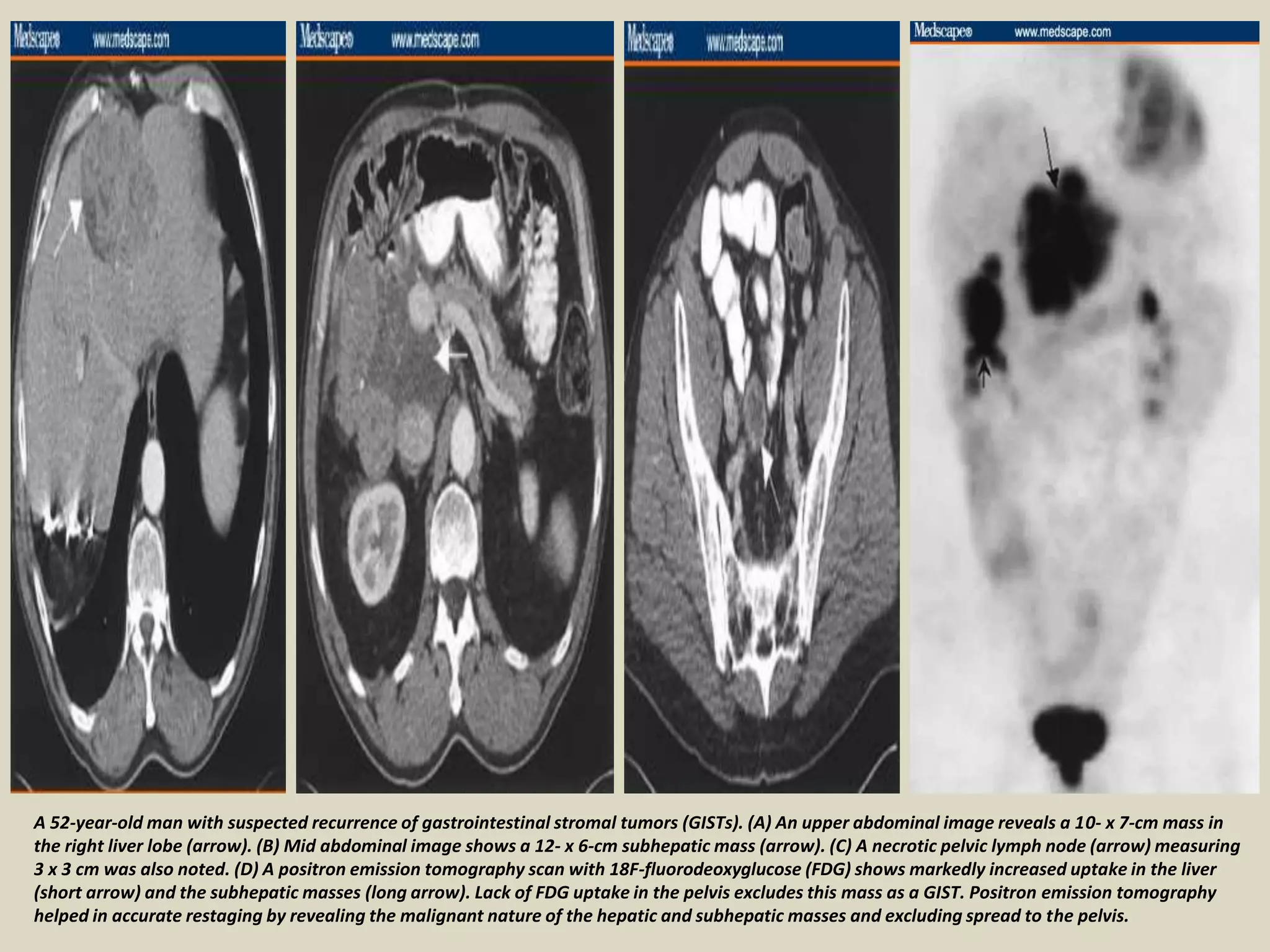 Presentation1, radiological imaging of gastro intestinal stromal tumour ...