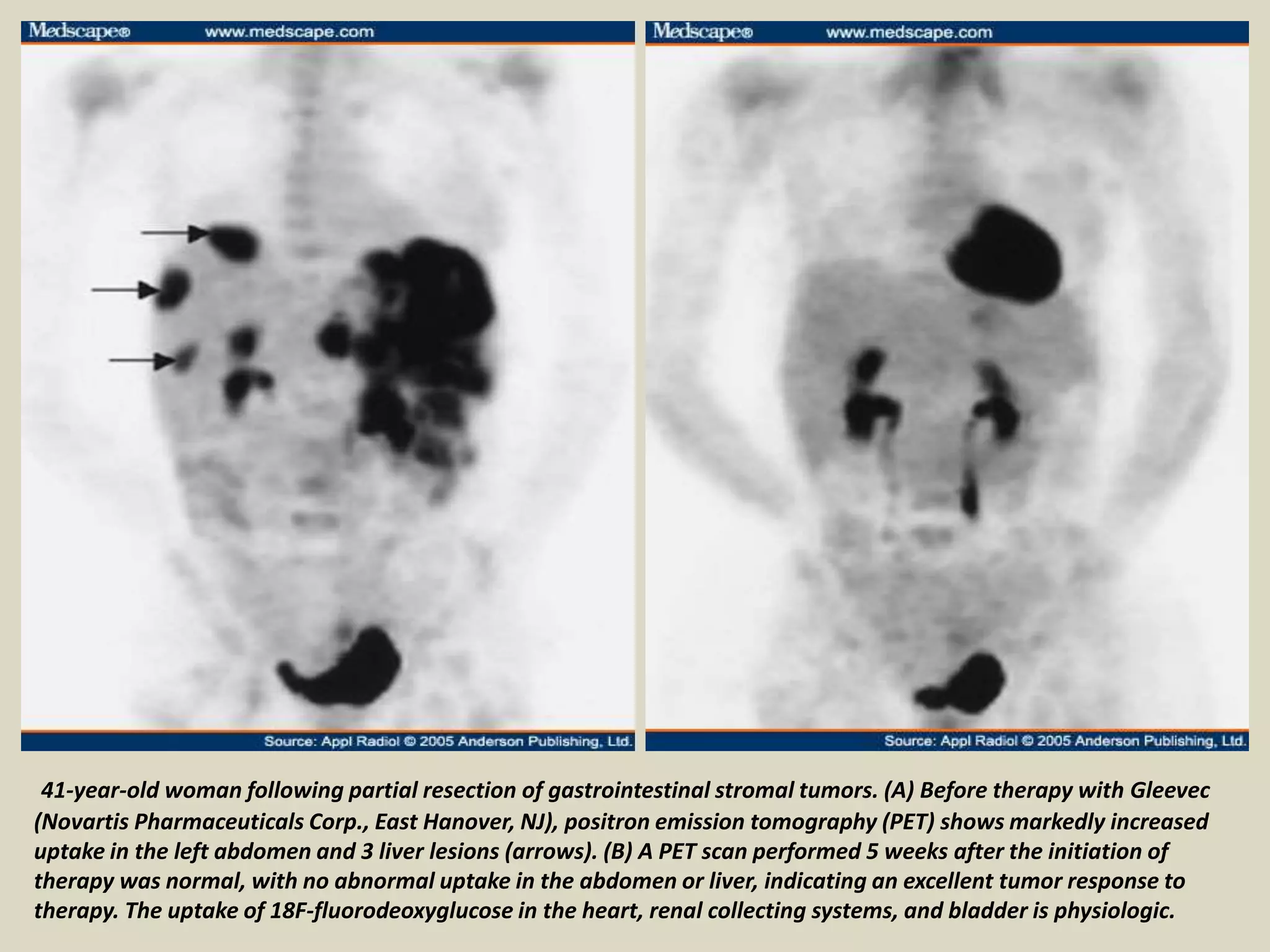 Presentation1, radiological imaging of gastro intestinal stromal tumour ...