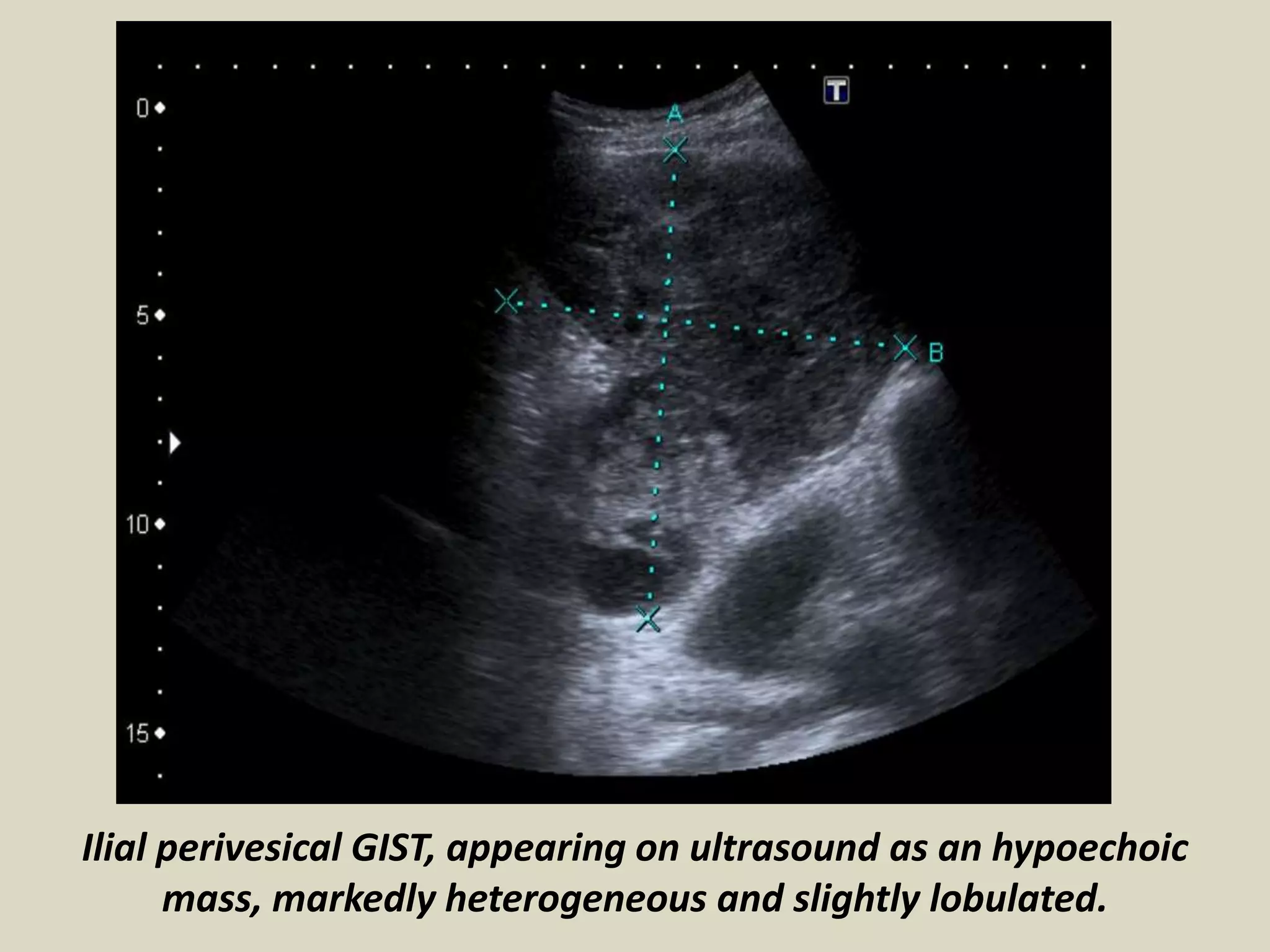 Presentation1, radiological imaging of gastro intestinal stromal tumour ...