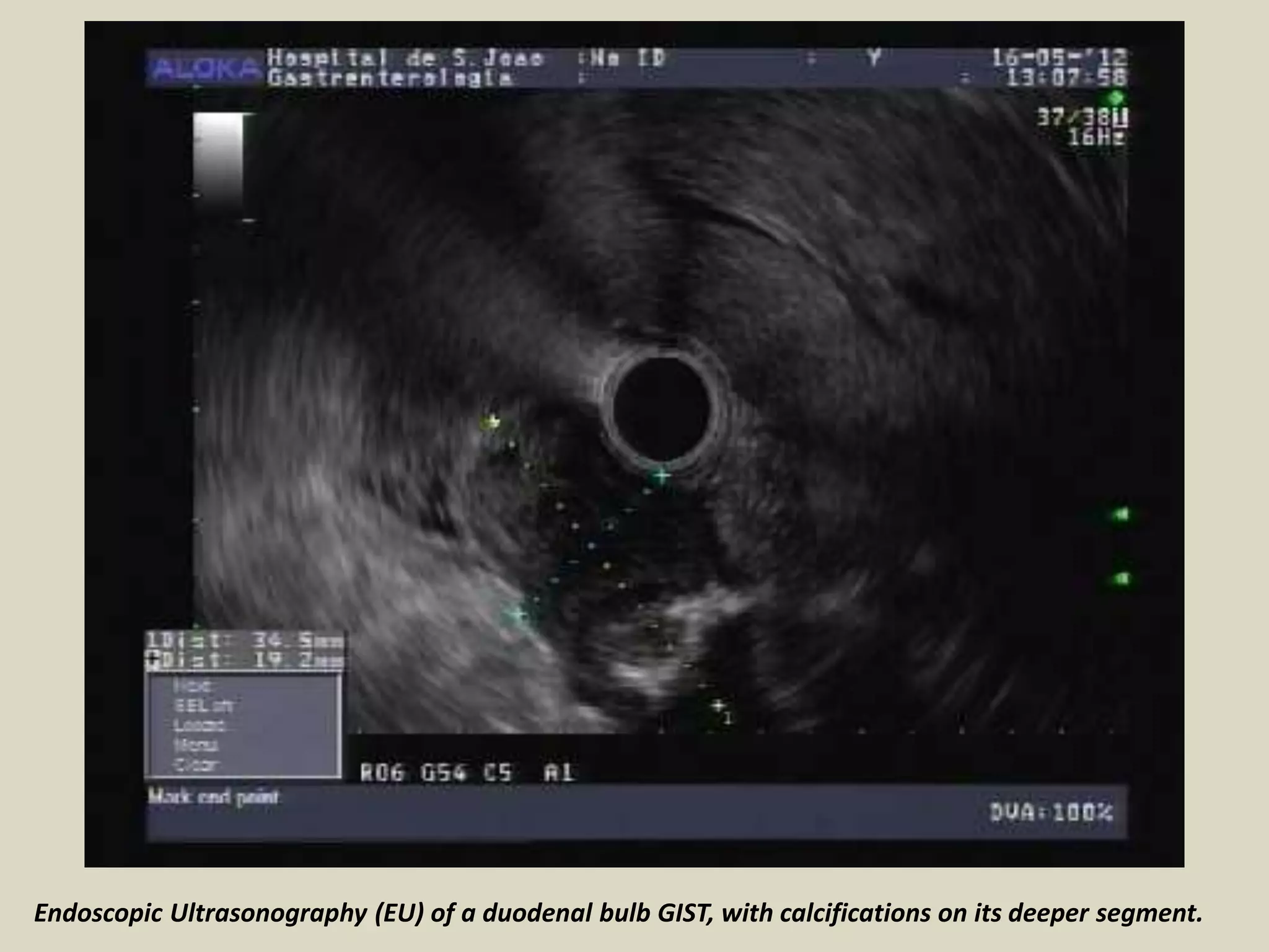Presentation1, radiological imaging of gastro intestinal stromal tumour ...