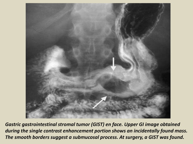 Presentation1, radiological imaging of gastro intestinal stromal tumour ...