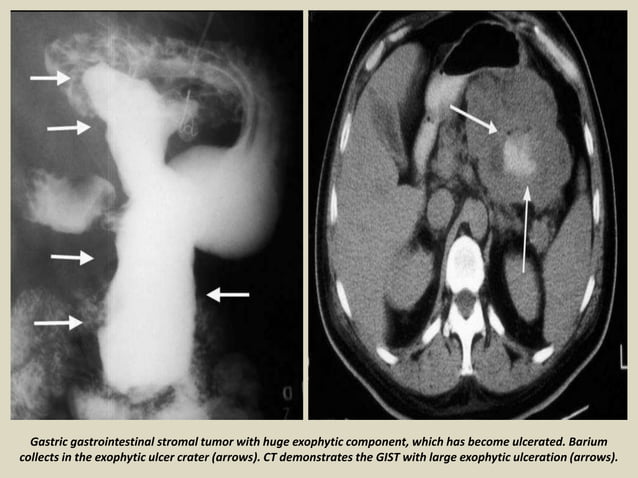 Presentation1, radiological imaging of gastro intestinal stromal tumour ...