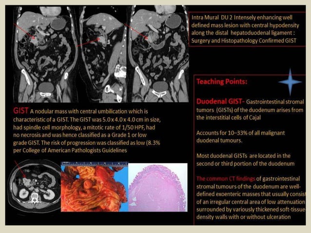 Presentation1, radiological imaging of gastro intestinal stromal tumour ...