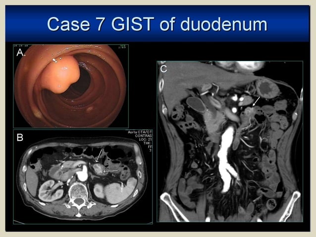 Presentation1, radiological imaging of gastro intestinal stromal tumour ...