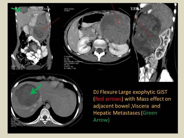 Presentation1, radiological imaging of gastro intestinal stromal tumour ...