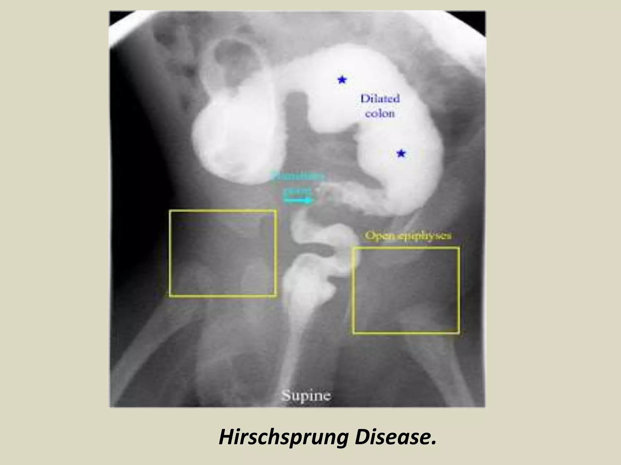 Hirschsprungs Disease Barium Enema
