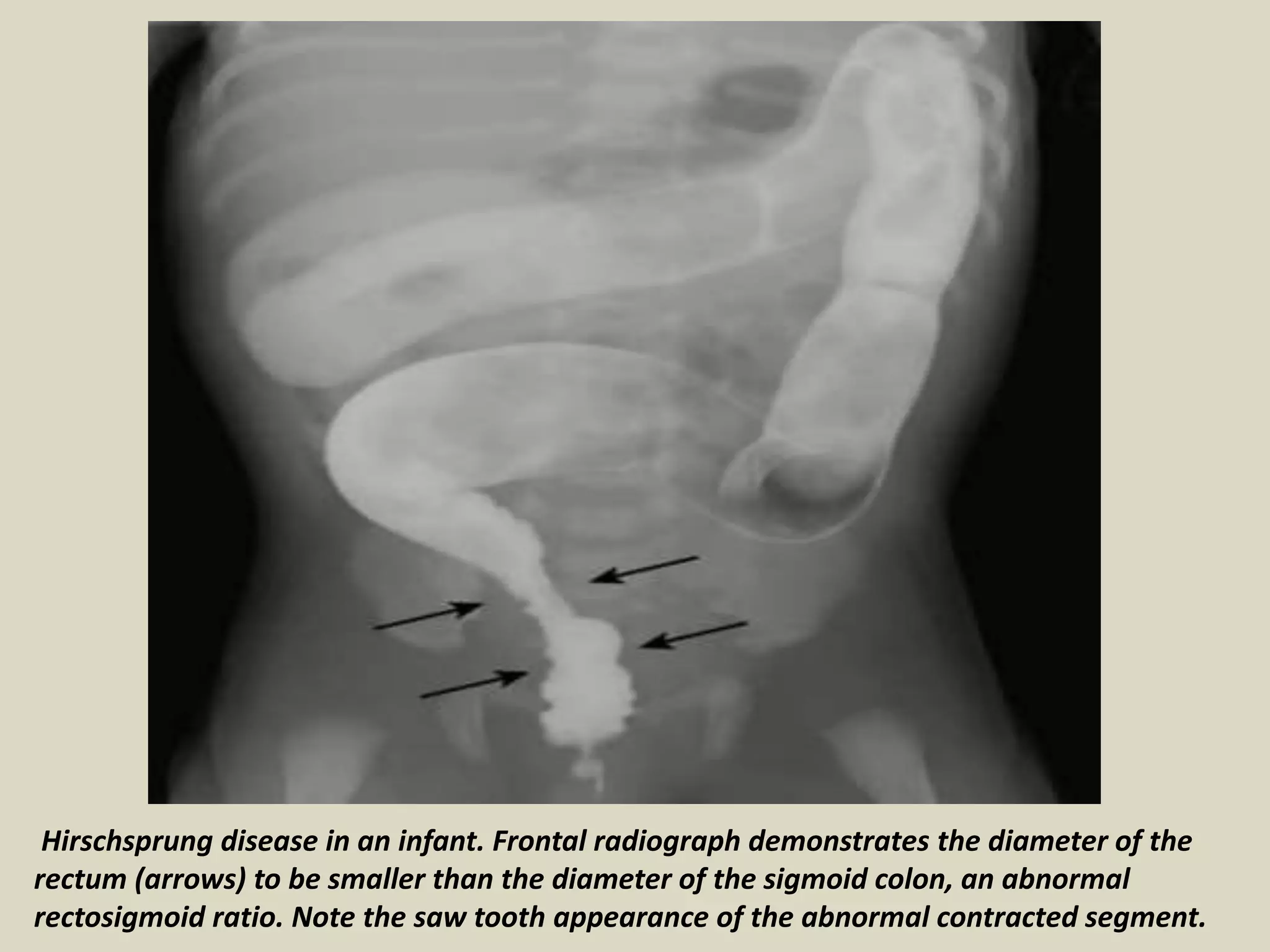 Hirschsprungs Disease Barium Enema