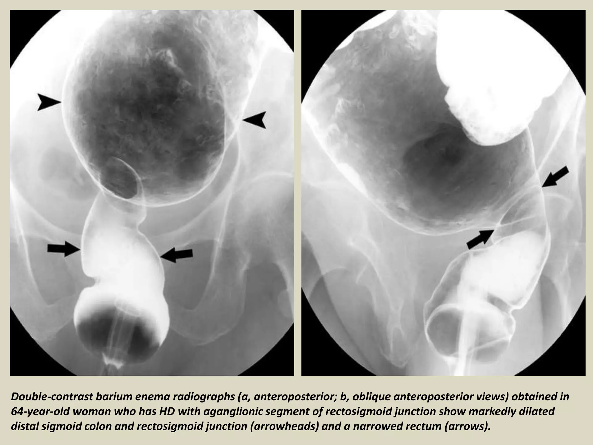 Presentation1, radiological imaging of hirshsprung disease. | PPTX