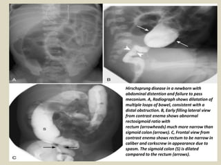 Presentation1, radiological imaging of hirshsprung disease. | PPTX