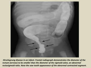 Hirschsprung Disease X Ray