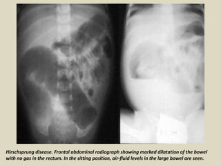 Hirschsprung Disease X Ray