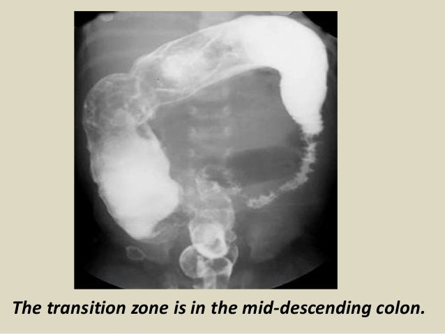 Presentation1, radiological imaging of hirshsprung disease.