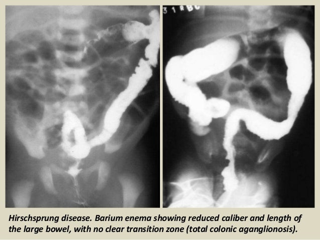Presentation1, radiological imaging of hirshsprung disease.